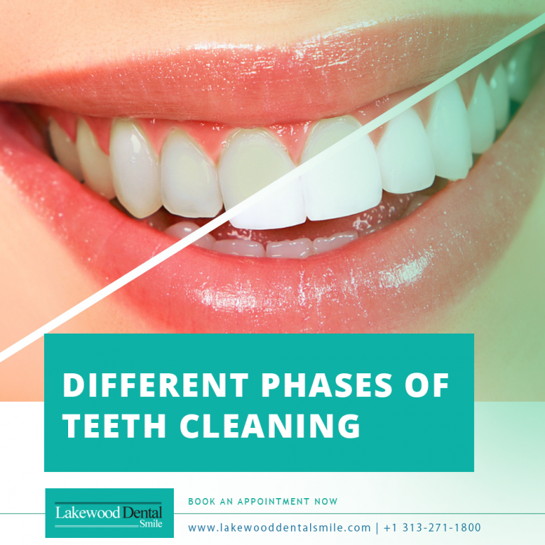 Different phases of teeth cleaning - Lakewood Dental Smile